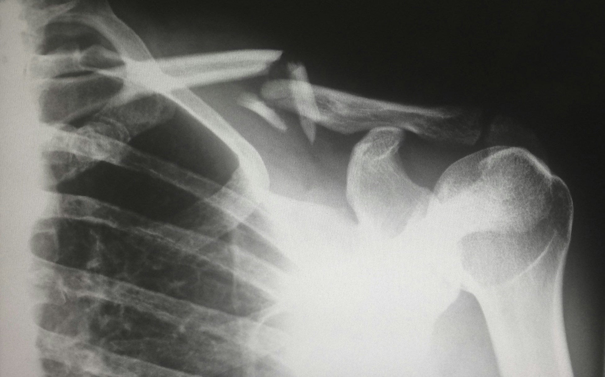 Common Snowboard Injuries: Signs, Treatment & Timeline – MobilityDuo